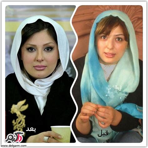 نیوشا ضیغمی قبل و بعد از عمل تصاویر