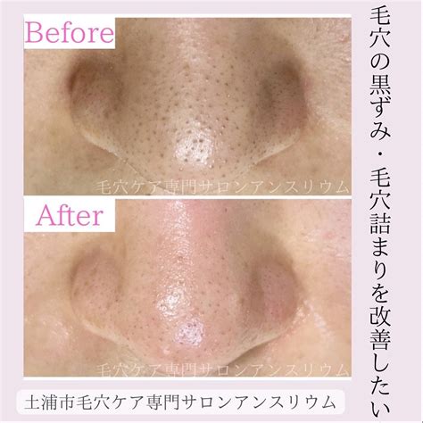 鼻の黒ずみどうしても取れない 茨城毛穴専門サロンアンスリウム 水貝茉以 土浦 つくば 水戸 毛穴の黒ずみ 毛穴の開き 角栓詰まり テカリ 赤み