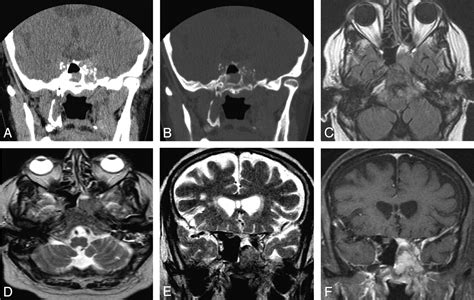 Ct And Mri Appearances Of Primary Sphenoid Melanoma A Rare Case
