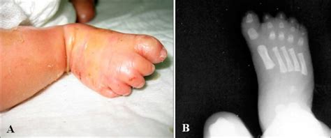 A Syndactyly Of The Second And Third Toes Of The Right Foot B