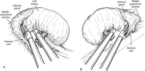 Laparoscopic Simple Nephrectomy Abdominal Key