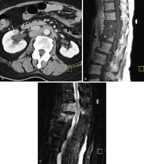 Cervical Cancer Radiology Key