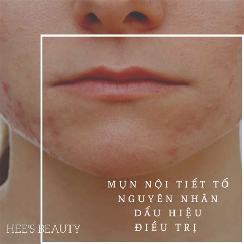Tìm Hiểu Về Mụn Nội Tiết Tố Long Thành Hees Beauty Clinic