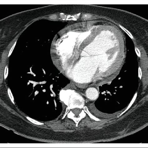 Axial Contrast Enhanced Computed Tomography Scan Demonstrates Small