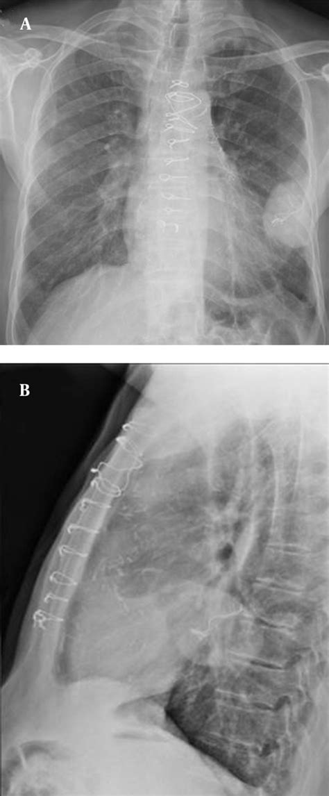 A Posteroanterior And B Lateral Chest Radiograph Revealed A