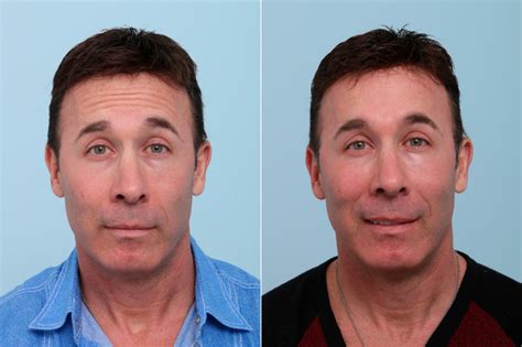 Botox Before And After Men