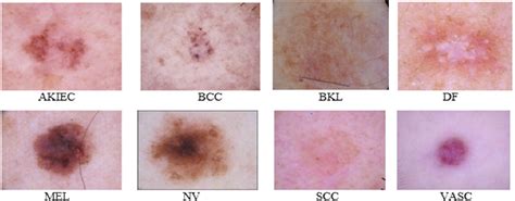 Figure 4 From Skin Lesions Classification Into Eight Classes For Isic