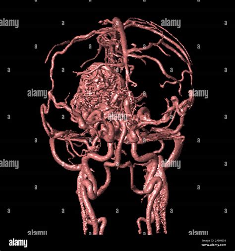 Brain Arteriovenous Malformation Image 1 Of 6 Coloured Magnetic