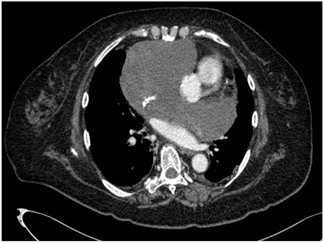 Contrast Enhanced Chest Computed Tomography Scan Confirmed The