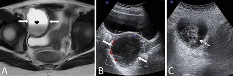 Hemorrhagic Ovarian Cysts In Two Different Patients A 20 Year Old