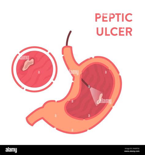 Peptic Ulcer Stomach Disease Endoscopy Diagnostic Infographics Stock