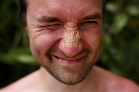 Premium Photo View Of Man With Sunburn Skin At The Beach