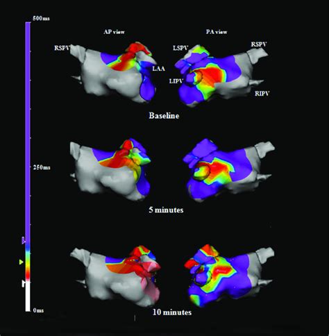 Representative Complex Fractionated Atrial Electrogram Cfae Maps