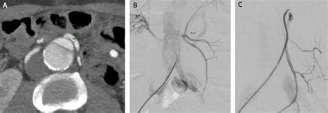 Ima Embolization During Index Evar Is It Worthwhile Endovascular Today