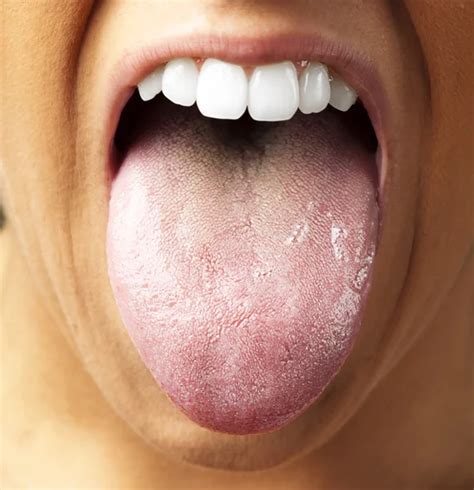 Unhealthy Under Tongue