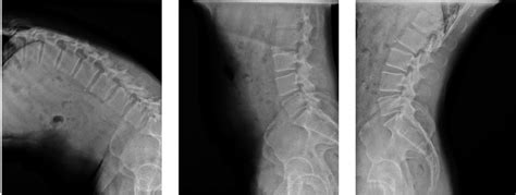 Lumbar Flexion And Extension