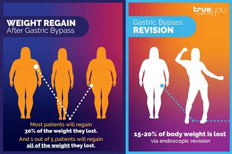 Take Two Gastric Bypass Revision Explained – True You Weight Loss 2022