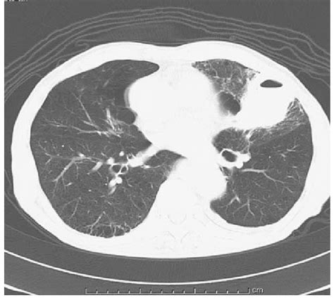 Chest Computed Tomography Ct On Admission Showing Mass Lesion With