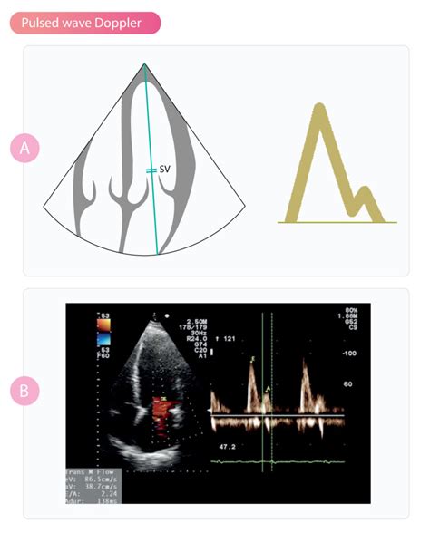Pulsed Wave Doppler Cardiovascular Education