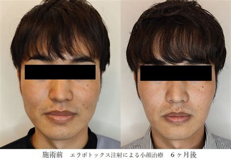 1回1分のエラボトックス注射であなたもすっきり小顔に