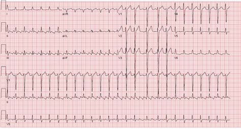 circulation tachydysrhythmias