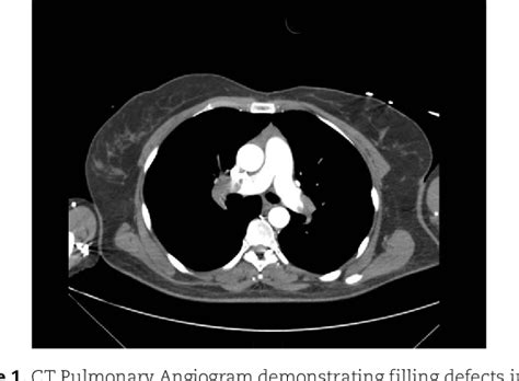 Figure 1 From Role Of Surgical Embolectomy In The Management Of Acute