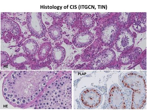 Figure 1 [histology Of Germ Cell Neoplasia ] Endotext Ncbi