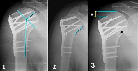 Correlation Of Radiological Parameters To Functional Outcome In Complex