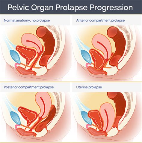 Pelvic Organ Prolapse Mohamed Elnasharty