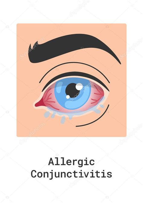Conjuntivitis Alérgica Enfermedad Ocular Vector Ilustración Vector De