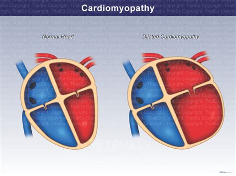 Dilated Cardiomyopathy Trial Exhibits Inc