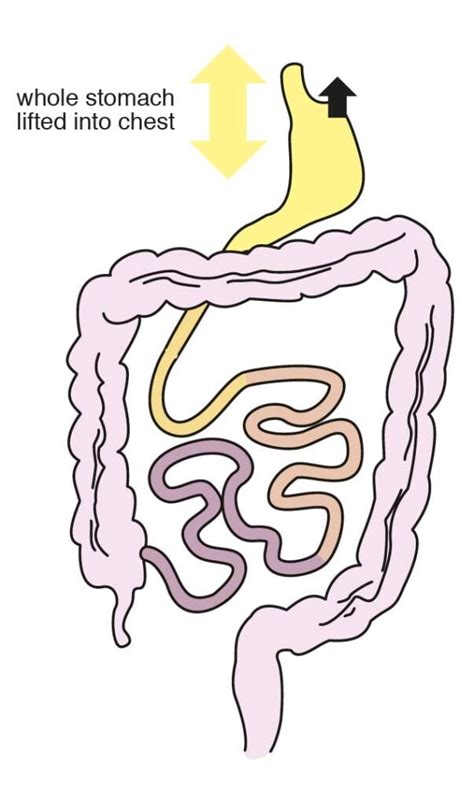 Gastric Transposition – Tofs Oa Tof Support