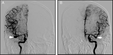 A A Digital Subtraction Angiography Anteroposterior Projection With