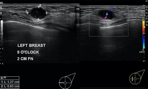 Ultrasound Examination Demonstrated Well Defined Hypoechoic Lesion