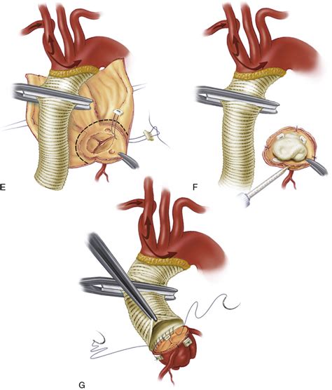Surgical Therapy For Aortic Dissection Thoracic Key