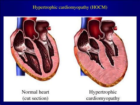 ppt hypertrophic obstructive cardiomyopathy case