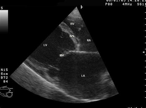 Dilated Cardiomyopathy — Medlibes Online Medical Library