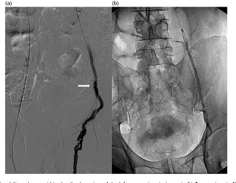 Embolization Of Varicocele Semantic Scholar