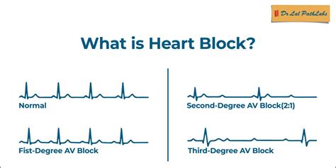Heart Block Symptoms And Diagnosis Dr Lal Pathlabs Blogs