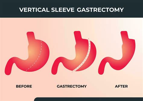 Laparoscopic Sleeve Gastrectomy Vertical Gastrectomy Weight Loss