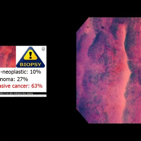 Prediction Of Colorectal Polyp Histology By The Endobrain Download