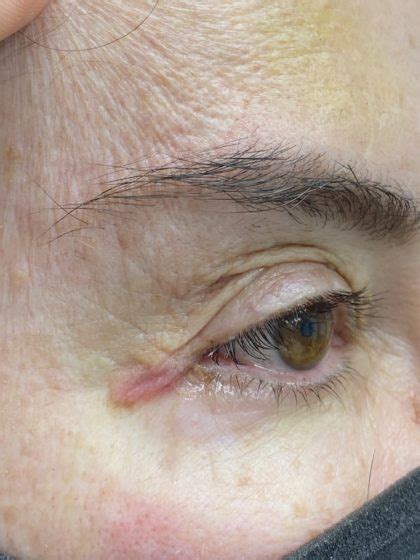 Patient 1436 Cyst Removal Before And After Photos Alhambra Plastic