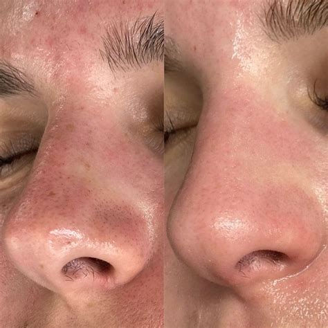 Blackhead Extraction Facial Facial Telford Hydrafacial Extraction