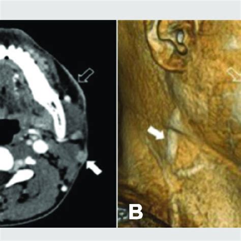 A Transverse Contrast Enhanced Computed Tomography Ct Scan Showing