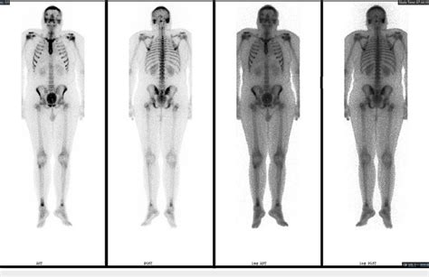 Tc 99m Mdp Bone Scintigraphy Showed Bilaterally Increased Uptake Within