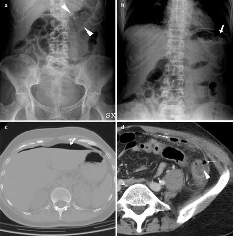 Radiographic And Ct Imaging Assessment Of Acute Exacerbations And