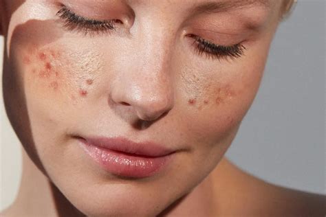 آکنه چیست؟ علل، انواع و درمان آن برایت مکس