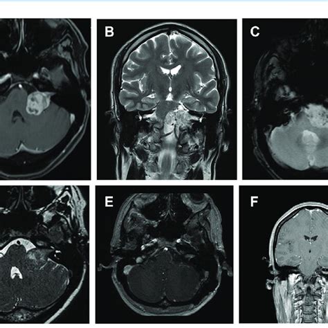 Preoperative And Postoperative Magnetic Resonance Imaging Mri Of A