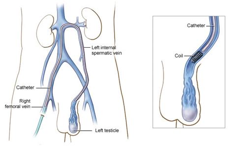 Variocele Surgery Laparoscopic Varicocelectomy Mumbai India