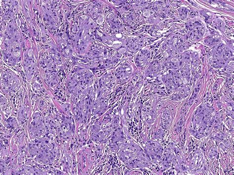 Pathology Outlines Granular Cell Tumor